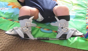 The Ponseti Method: A Step-by-Step Guide to Clubfoot Correction and ...